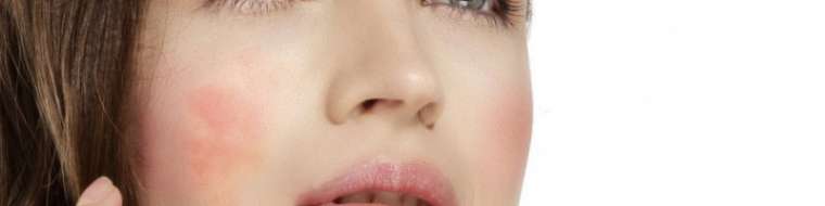 Les angiomes | Dr Isabelle Escoffier-Pietri