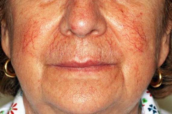 La couperose | Dr Isabelle Escoffier-Pietri